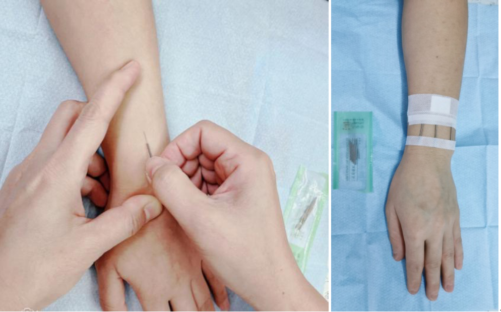 Replace "medicine" with "needle"!TCM technology cleverly solves ...