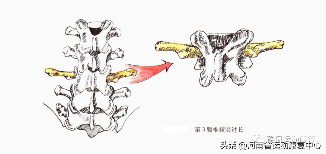 Is back pain a lumbar muscle strain? - iNEWS
