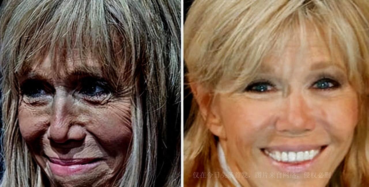 The beautiful first lady of France underwent 3 hours of facial surgery ...