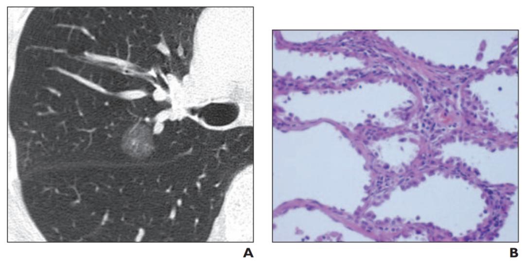 Differential diagnosis of pulmonary nodules - CT case with pathological ...