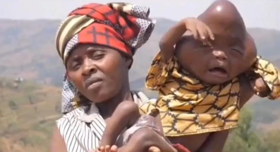 African boy with facial deformity resembling aliens was abandoned by ...