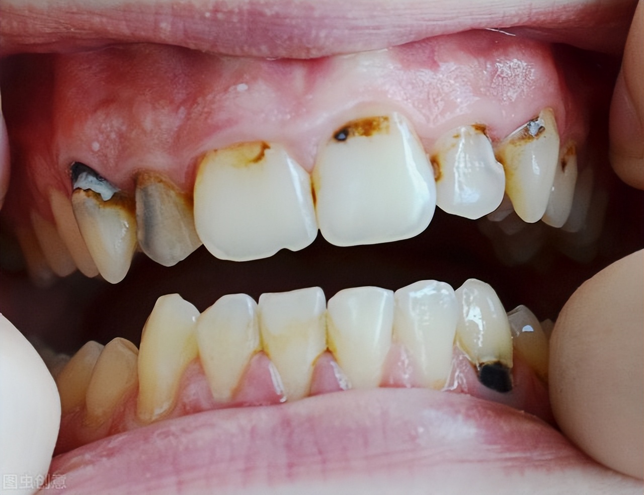 Dry mouth and thirst may not be a sign of dehydration, or an immune ...
