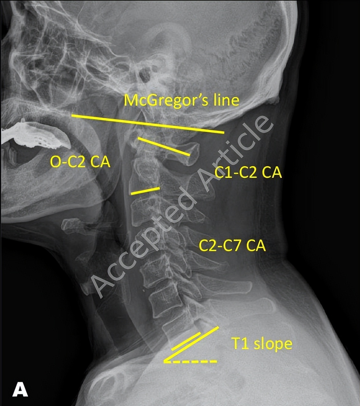 Radiological parameters and clinical outcomes after C1-2 posterior ...