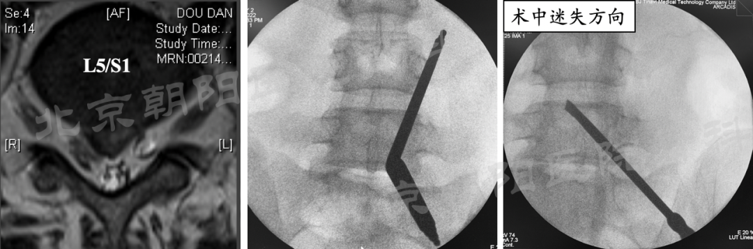 20 cases of UBE surgery learning curve - iNEWS