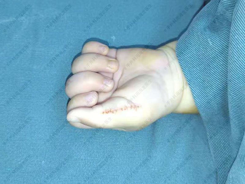 How long does it take to recover after the child has an extra finger ...