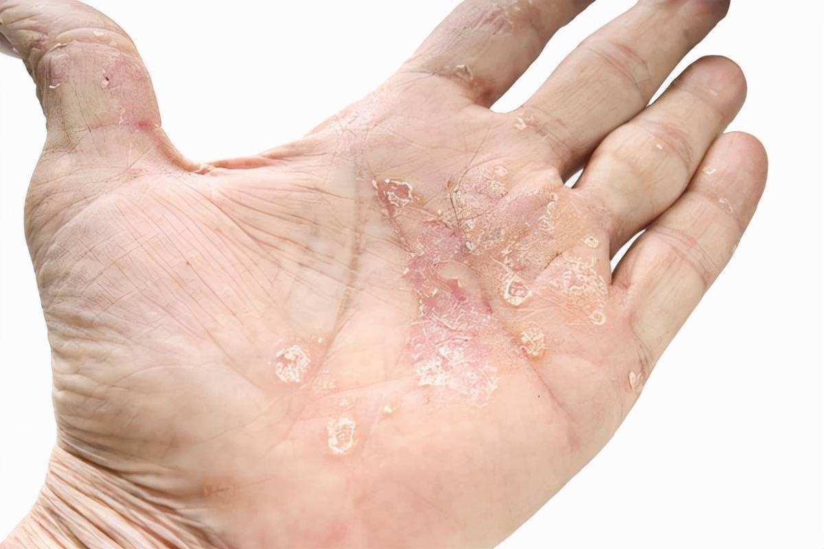 What causes peeling skin and ringworm on hands and feet?How to treat ...