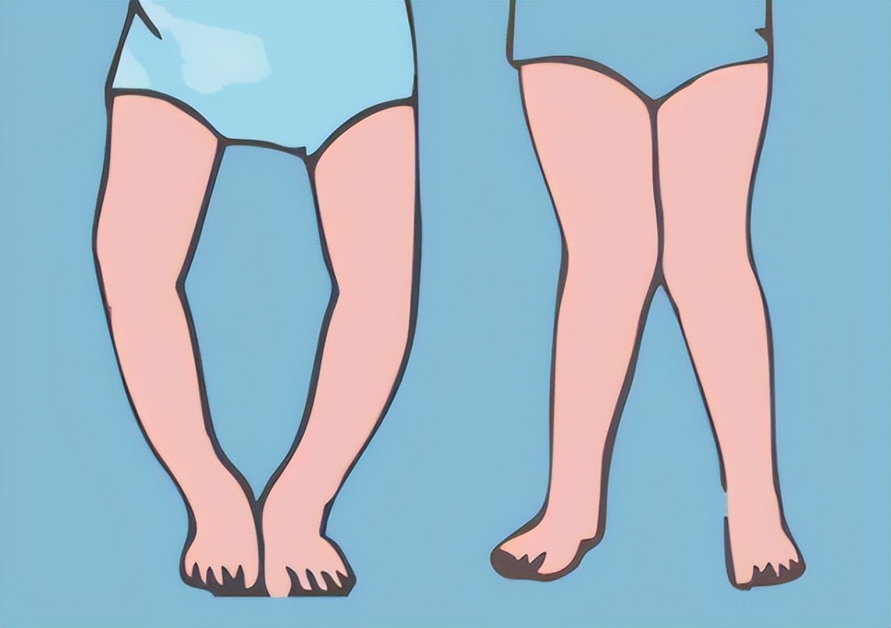 Should O-shaped legs be corrected once or gradually, how should I ...