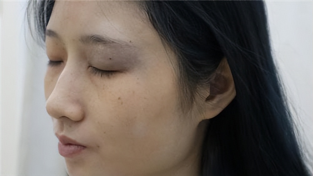 Blue rubber bubble nevus syndrome, understand it is very rare - iNEWS