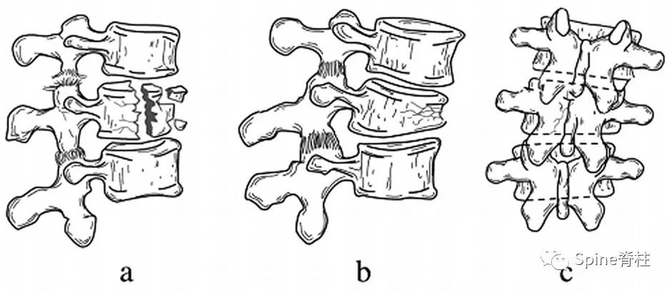 AO classification of thoracolumbar fractures and TLICS, load sharing ...