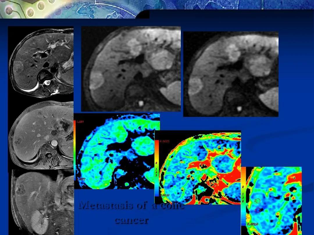What is MRI diffusion? - iMedia