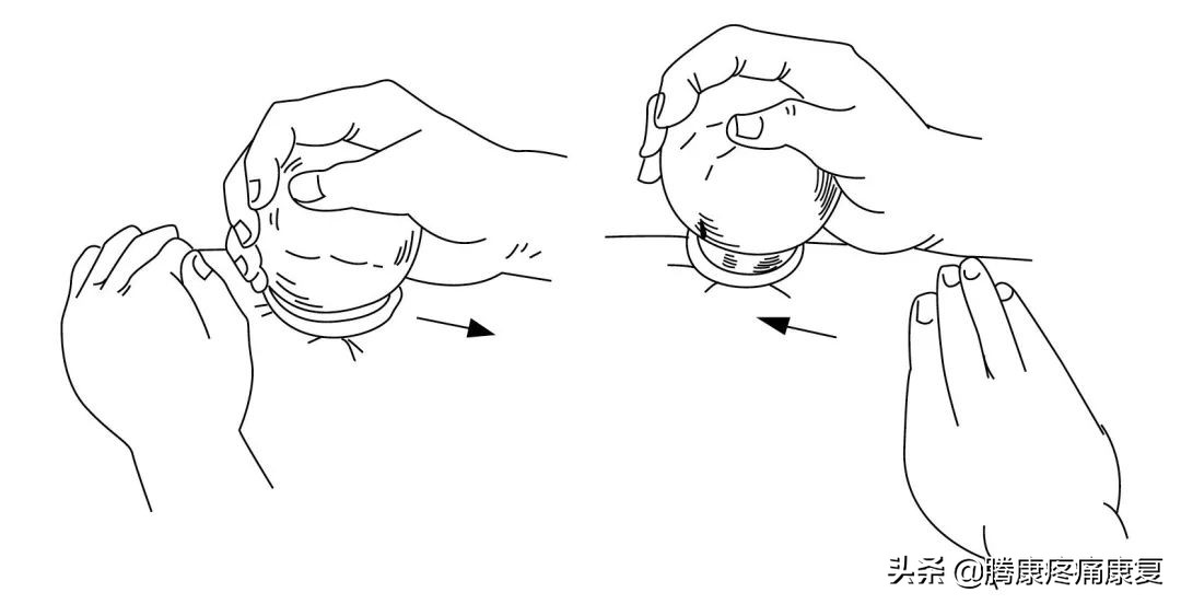 Cupping Treatment of Scar - iNEWS
