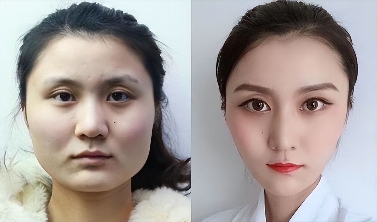 What happened to those bone-shaved actresses? Are there side effects ...