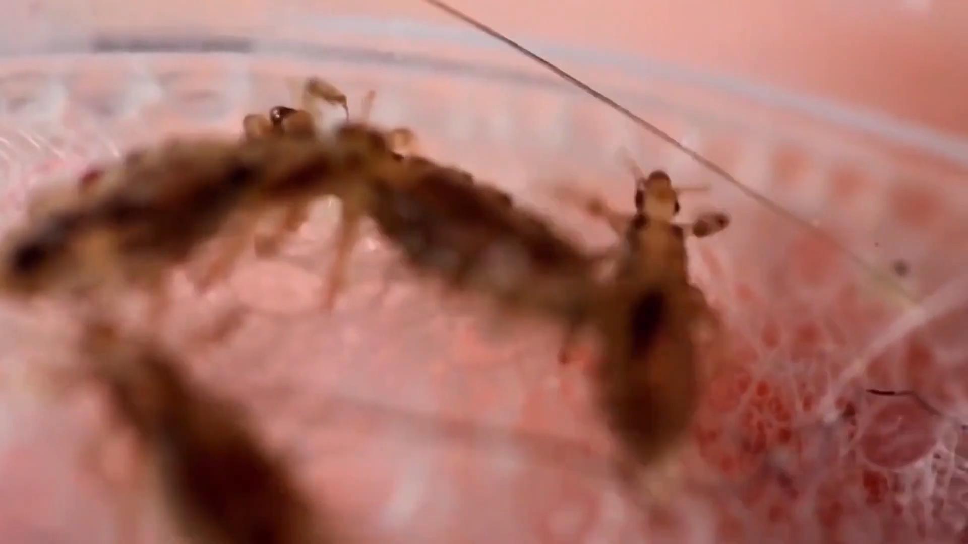 Lice that used to be common but are now hard to see? What are the ...