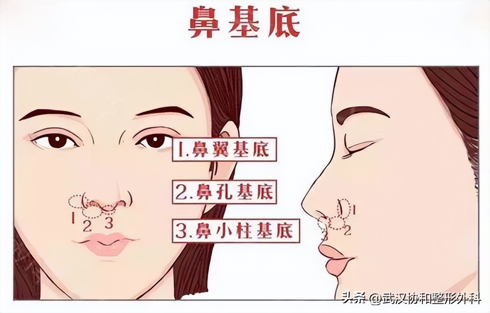 How to choose the material of nasal underfill? - iNEWS