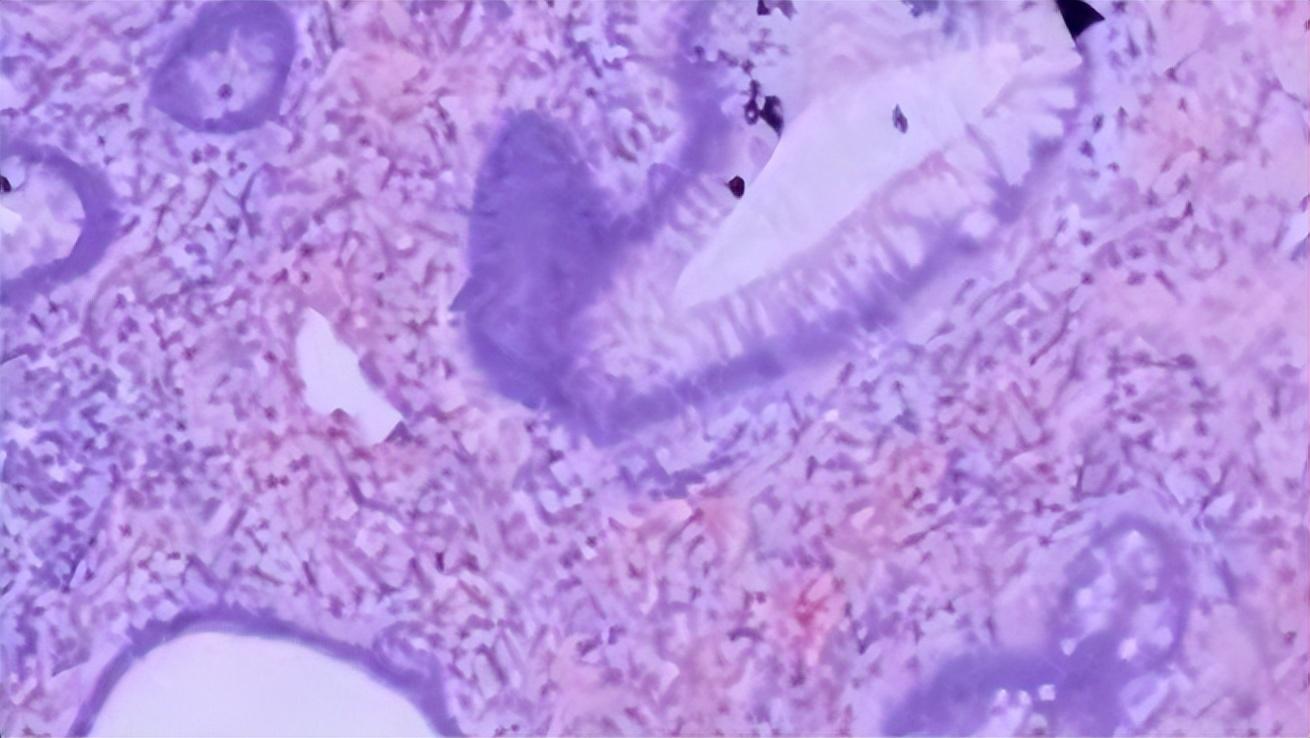 Application progress of endoscopic technique in ulcerative colitis - iMedia