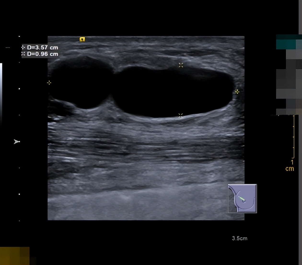 Lobular carcinoma in situ accidentally discovered during breast cyst ...