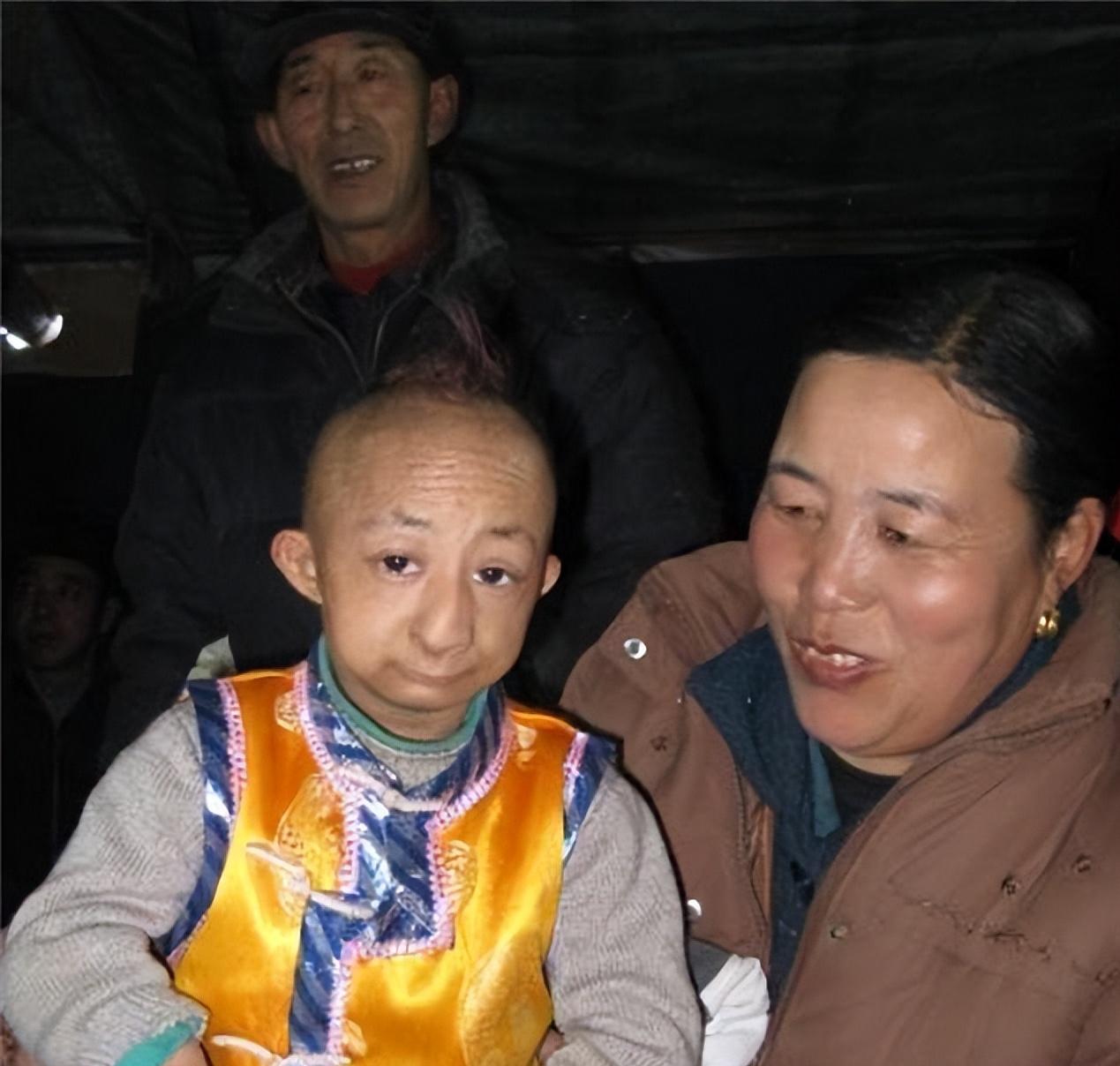 He Pingping: He became "the world's first dwarf" at the age of 19, died ...