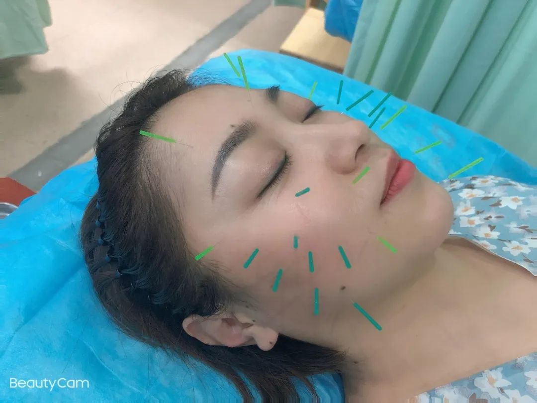 Acupoint catgut embedding + beauty acupuncture, two-pronged treatment ...