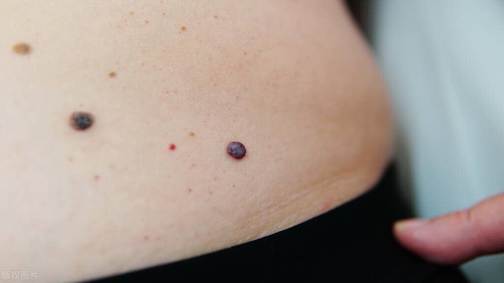 Malignant melanoma manifestations - iMedia