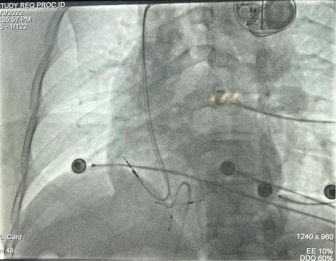 The implantation of the pacemaker only takes 6 steps, easy to ...
