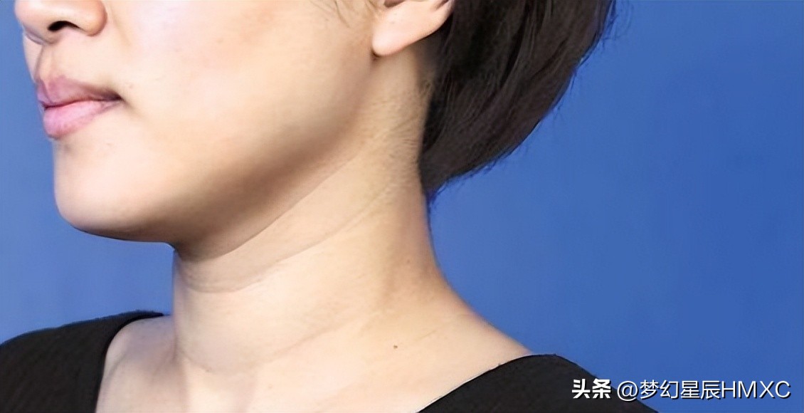 "3 stripes" appear on a woman's neck, do you know what it means? stop ...