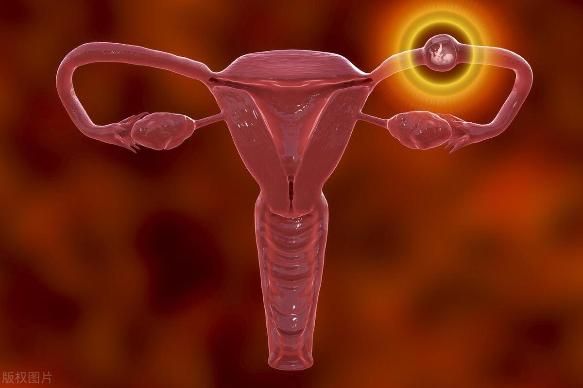 Ectopic pregnancy crisis: a 23-year-old girl's fallopian tubes ruptured ...