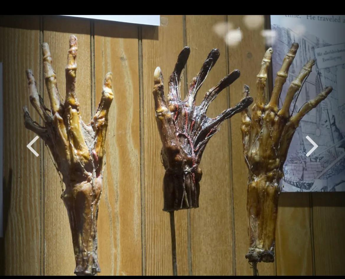 What You Didn't Know About Medical Abnormal Specimens on Display at the ...