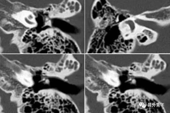 Common Abnormal Temporal Bone CT Summary - iNEWS