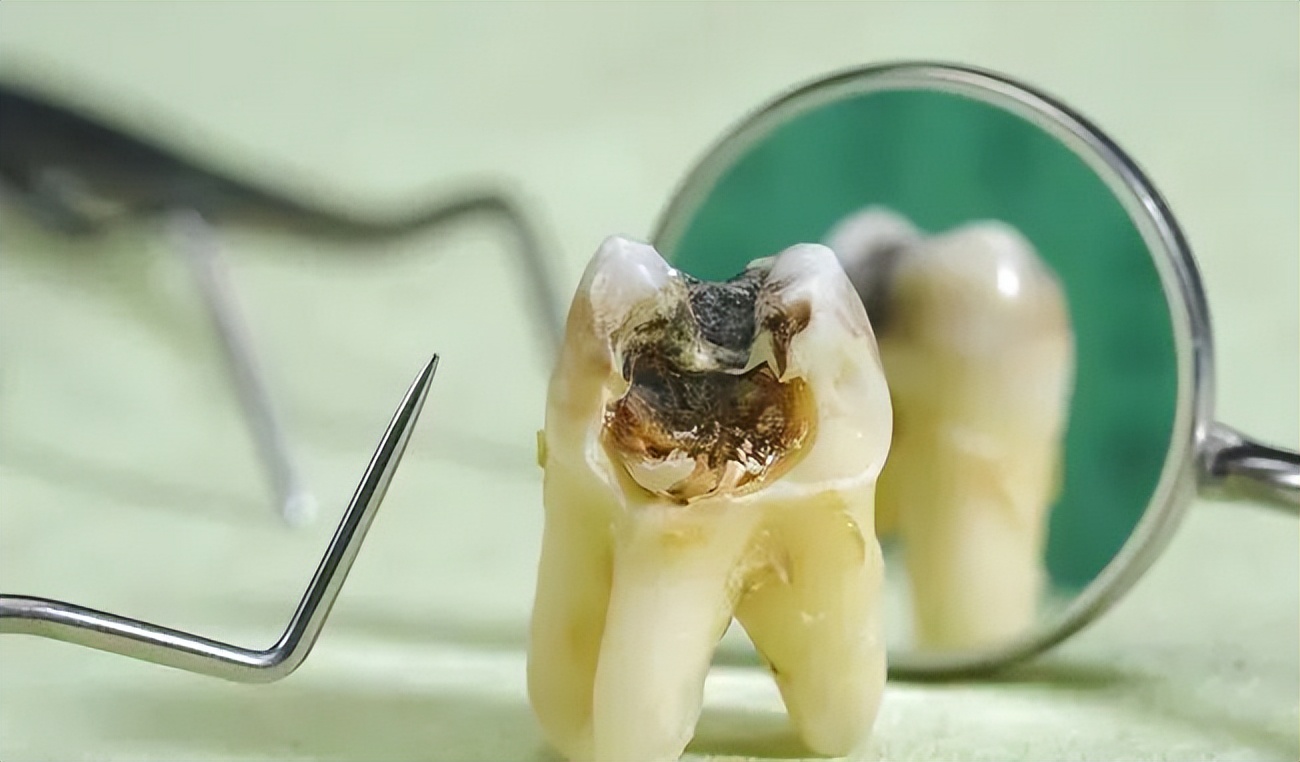 Won't the filled tooth go bad again? - iNEWS