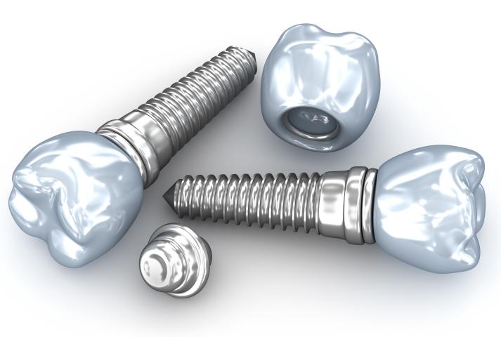 How long can dental implants last? Are they the same as real teeth ...