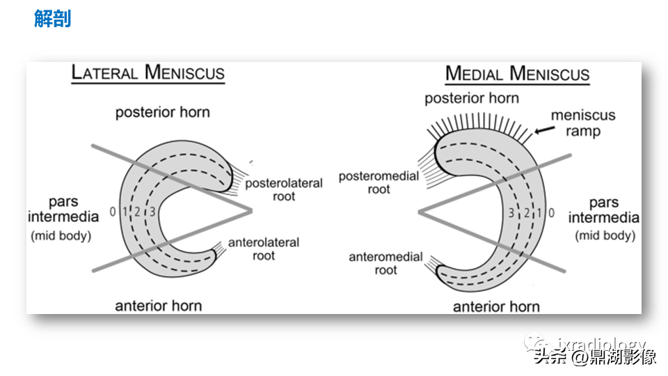meniscal root tear - iNEWS
