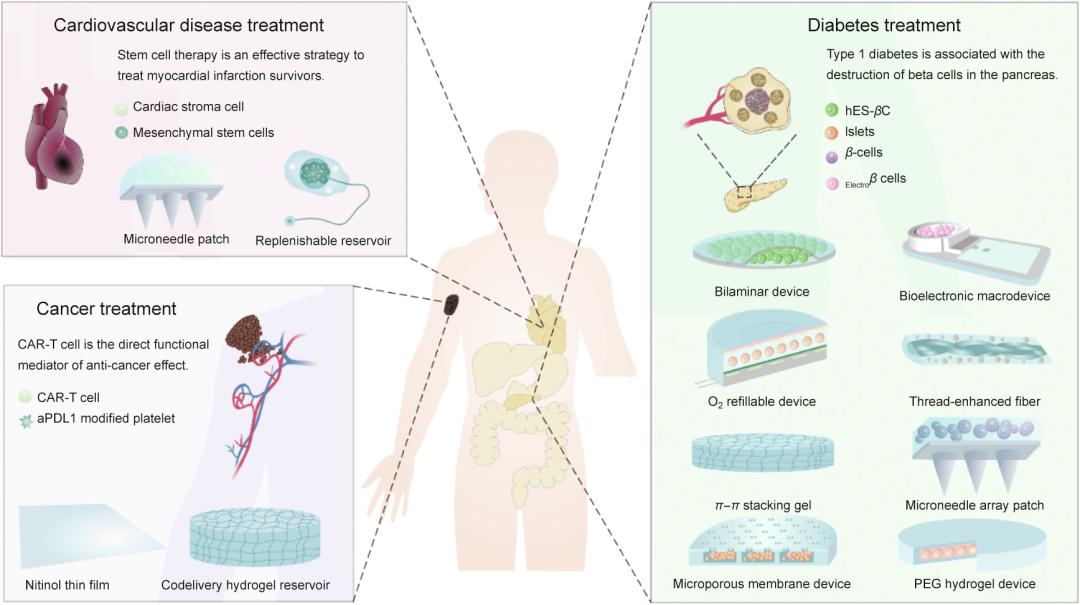Large-Size Loading Devices for Cell Therapy - iNEWS