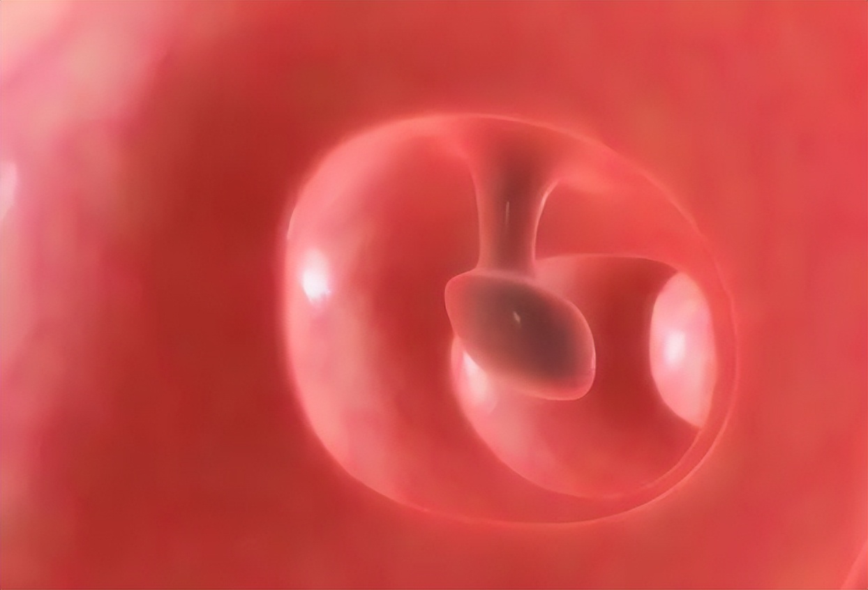 Are polyps a 'close relative' to cancer?How long does it take to go ...