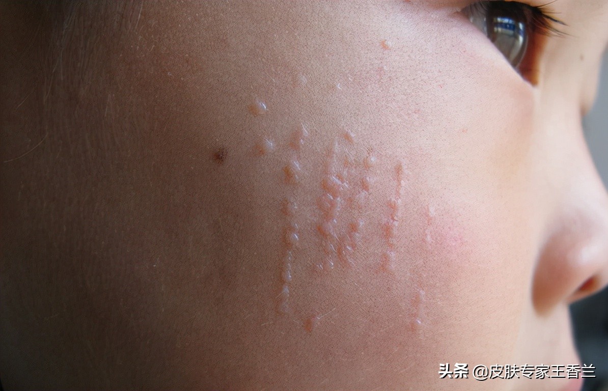 What are the small, painless, itchy bumps around the eyes? - iNEWS