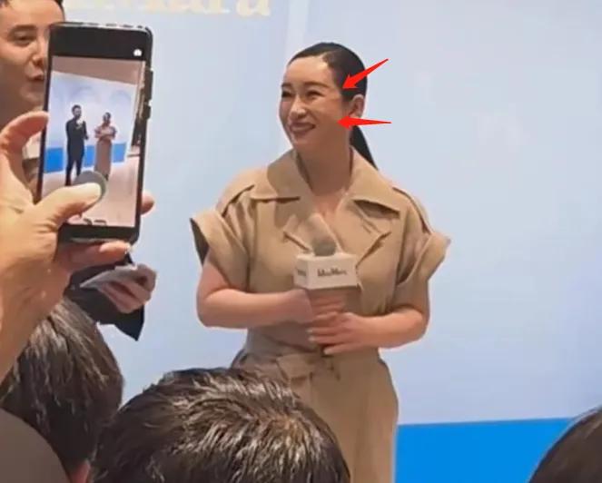 The star's face is swollen too terrible! With protruding forehead and ...