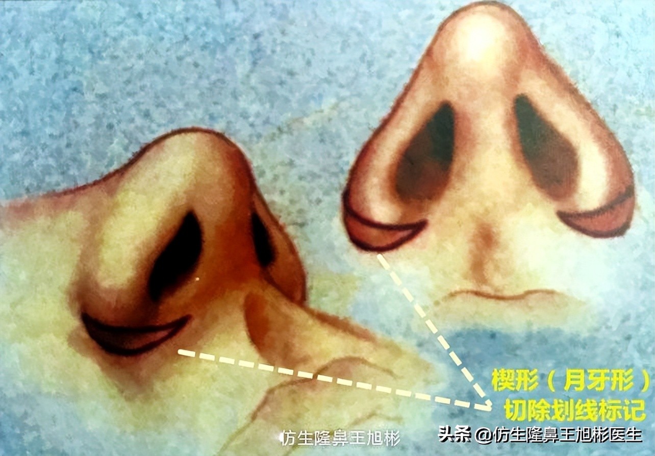 The width of the nose can also be divided into true and false. How to ...