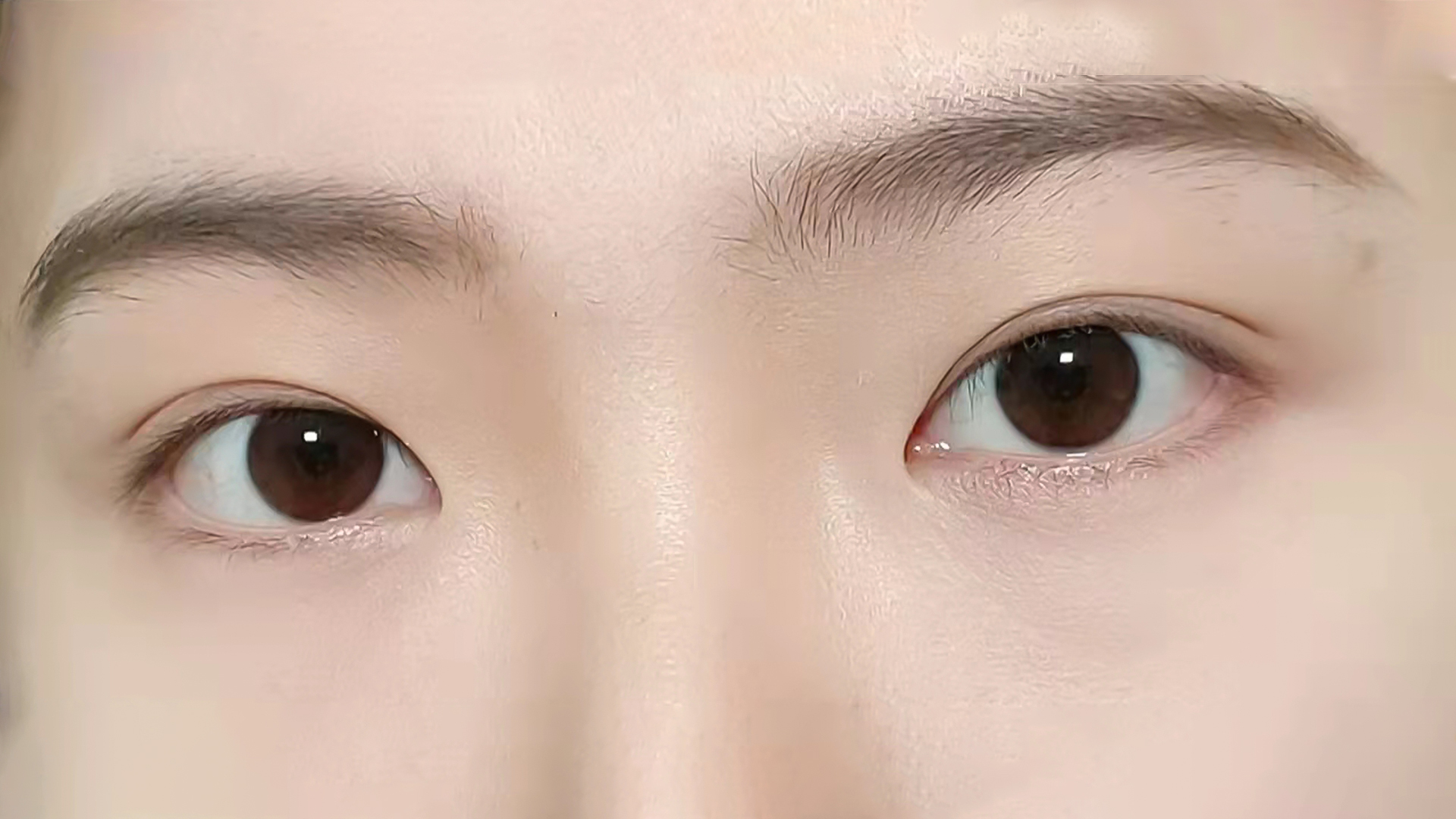 What should I do if the double eyelid shape is parallel and looks old ...