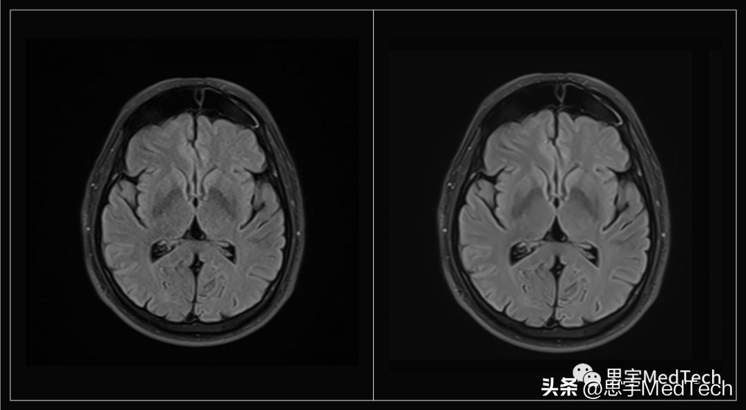 Approved by FDA! AI-Enhanced Magnetic Resonance Imaging - iNEWS