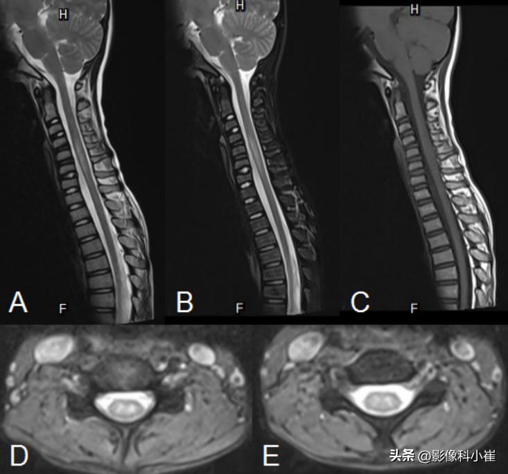 Classic Medical Image Library (52) - Myelitis - iNEWS