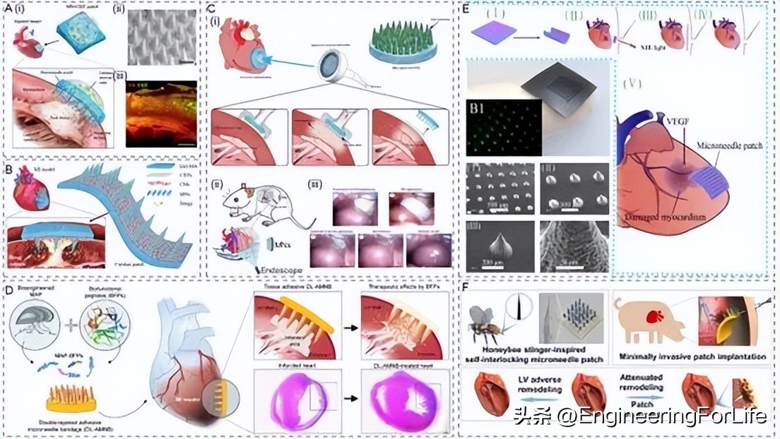 Design, manufacture and application of microneedles for wound and ...