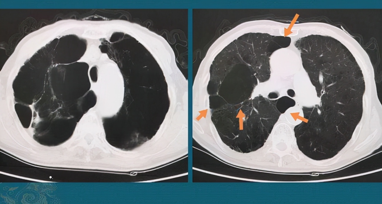 How to maintain the lung bullae to grow more slowly?How to prevent the ...