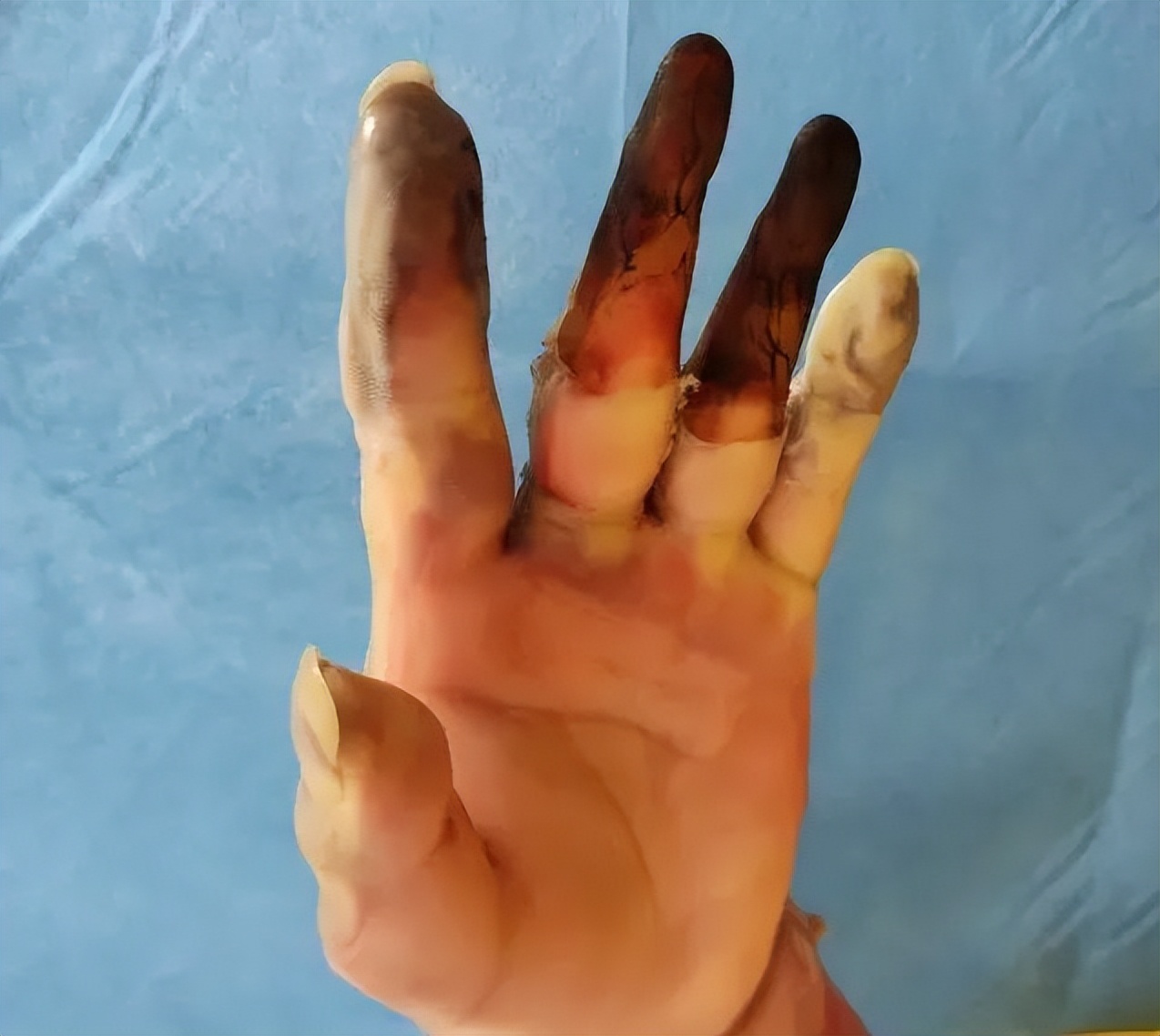 In addition to burns and scalds, what other diseases can the burn ...