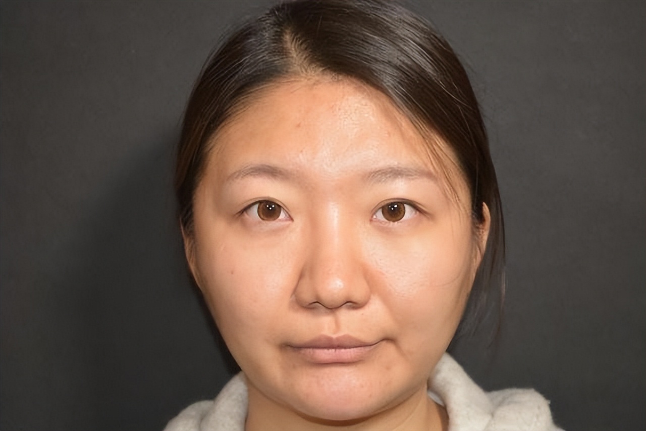 A girl from Xinjiang crossed half of China to have her nose reduced ...