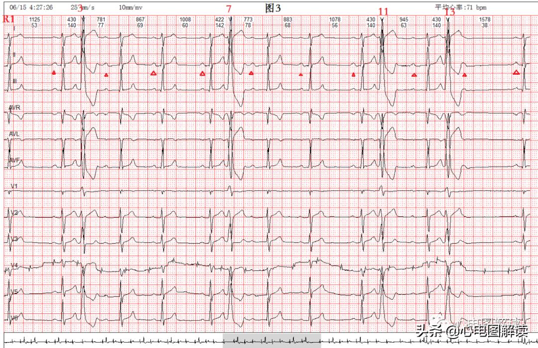 Intrusive premature ventricular contractions cause several consecutive ...