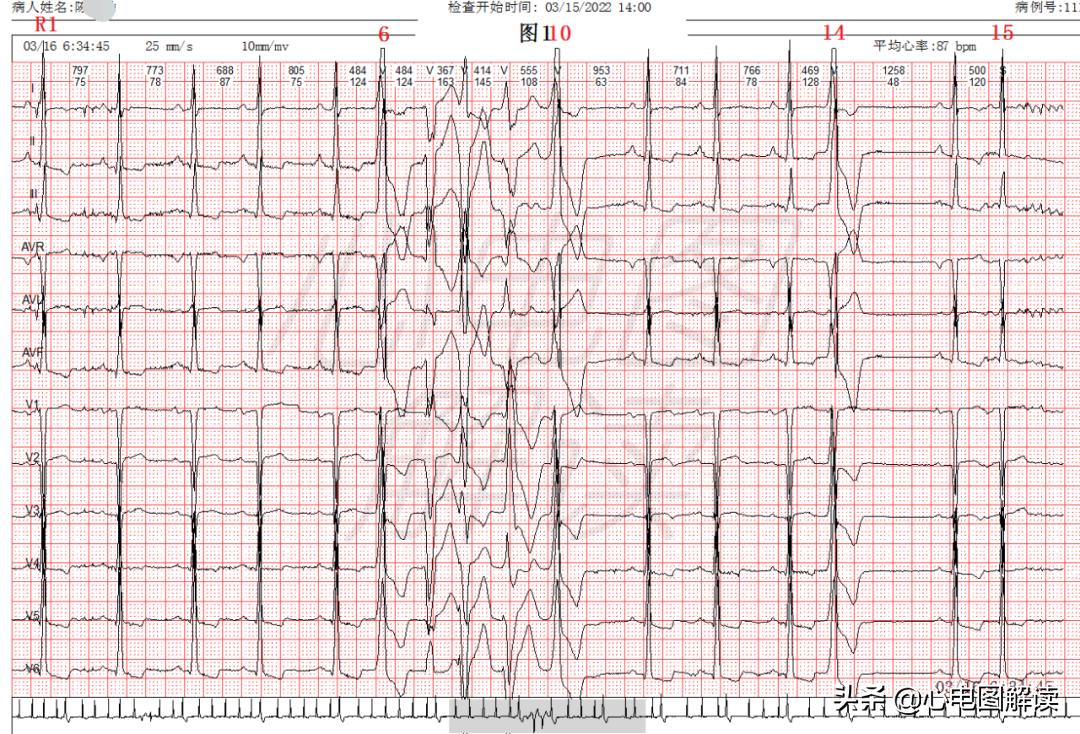 Multifocal ventricular tachycardia? - iNEWS