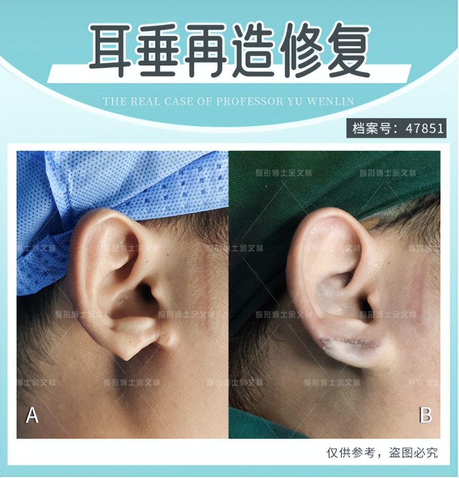 How can earlobe repair be performed for earlobe defect and earlobe ...