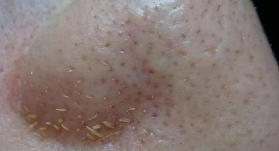 What are those little white particles that come out of my nose? - iNEWS