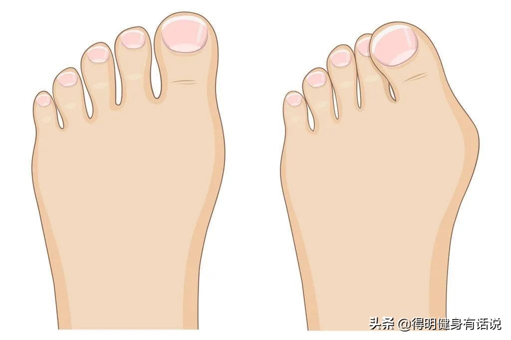 The danger of high heels is not just deforming your feet... - iNEWS