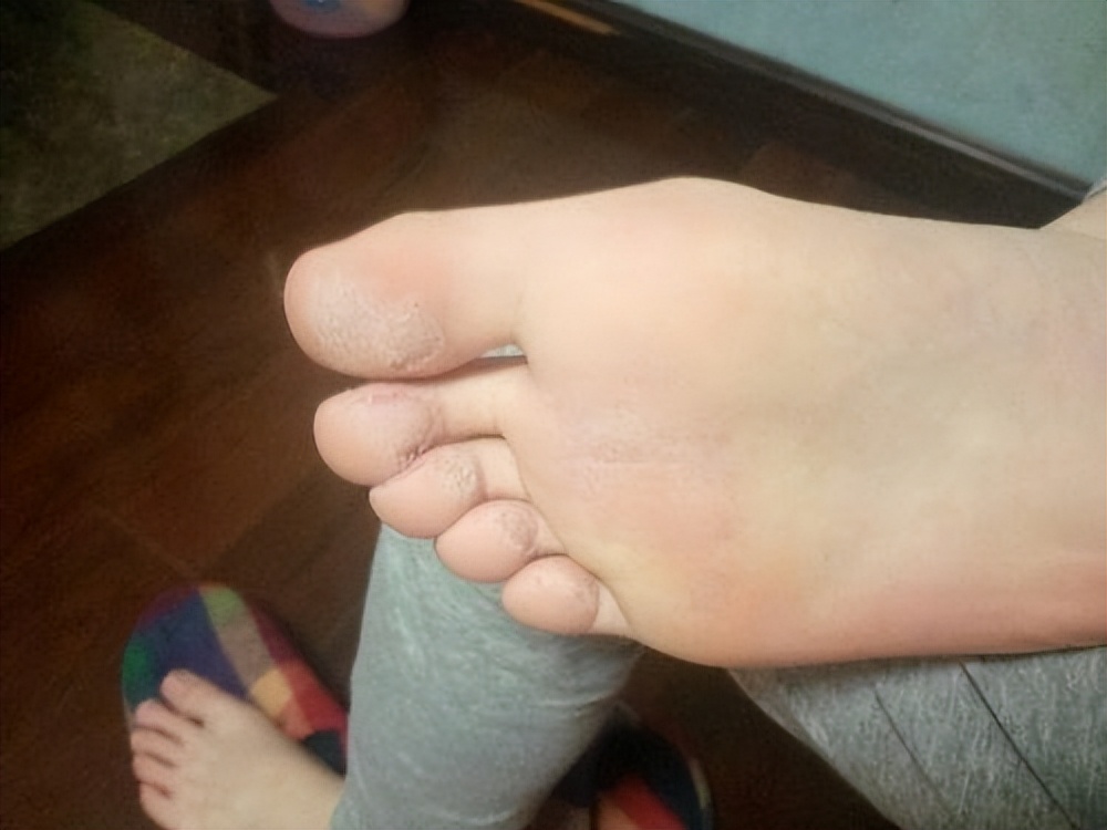 Bad liver, foot prophet?If your feet send out these 4 signals, it is ...