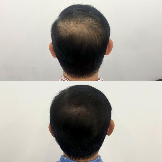 The latest anti-hair loss technology to help you grow hair in 3 months ...